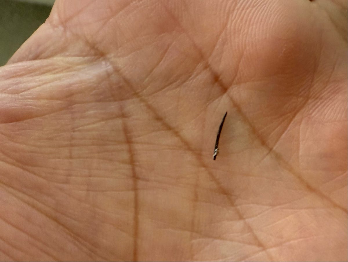 The Splinter Came Out After a Month! | by Dr. Seema Patel (PhD) | Never ...