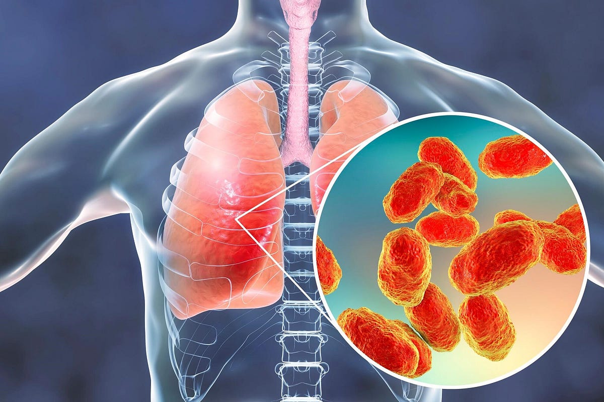 Best Herbal Solution For Pneumonia Medicine | by Chealth | Medium