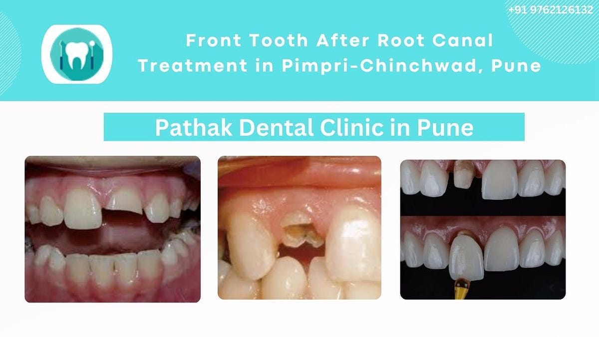 Front Tooth After Root Canal Treatment in Pimpri-Chinchwad, Pune - Pathak Dental Clinic - Medium