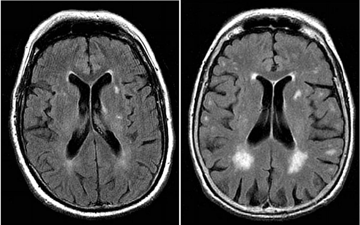 Brain MRI Segmentation with Segment Anything Model (SAM) Part 1 ...
