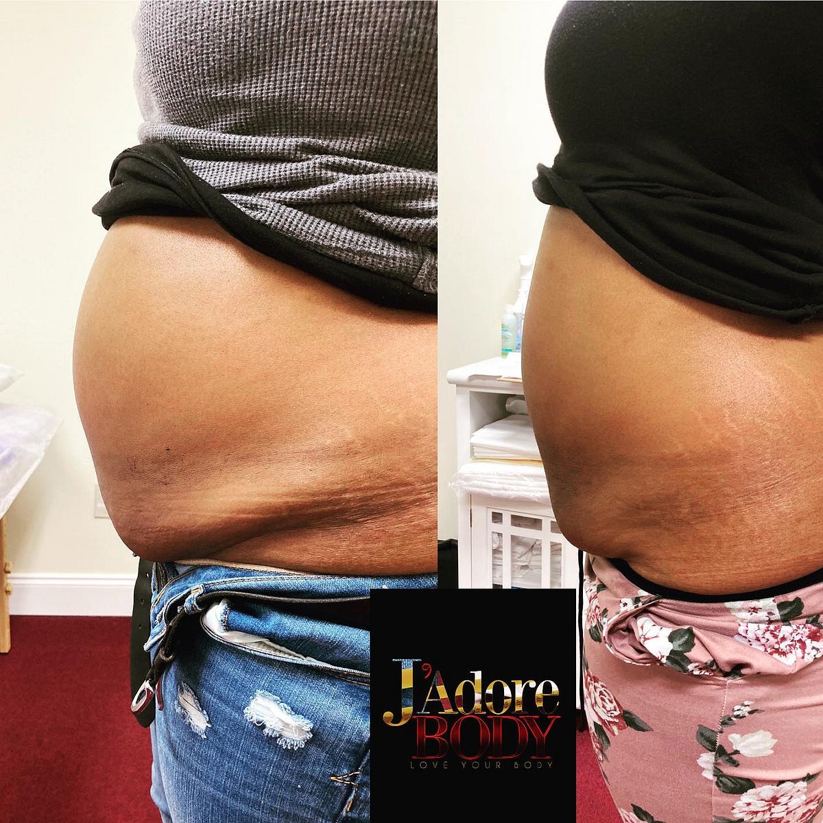 THE BEST BODY CONTOURING SERVICES IN MCDONOUGH - Jadorebody - Medium
