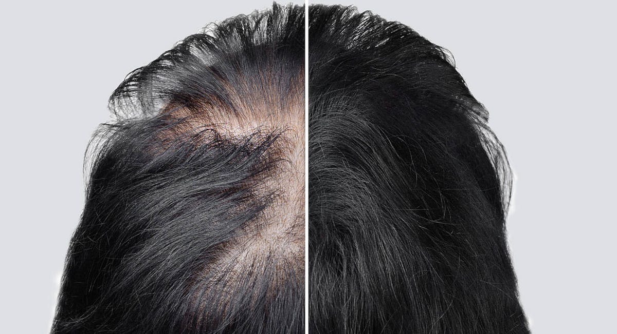 What are the different baldness cures and do they work? | by Raneem ...