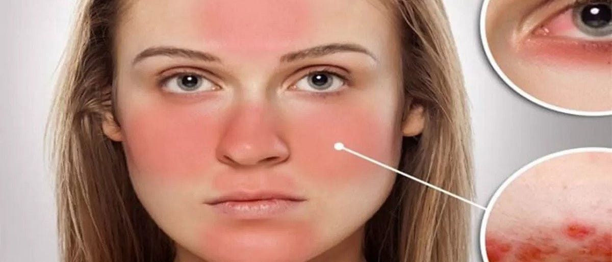 lupus erythematosus - Roshiitajo - Medium
