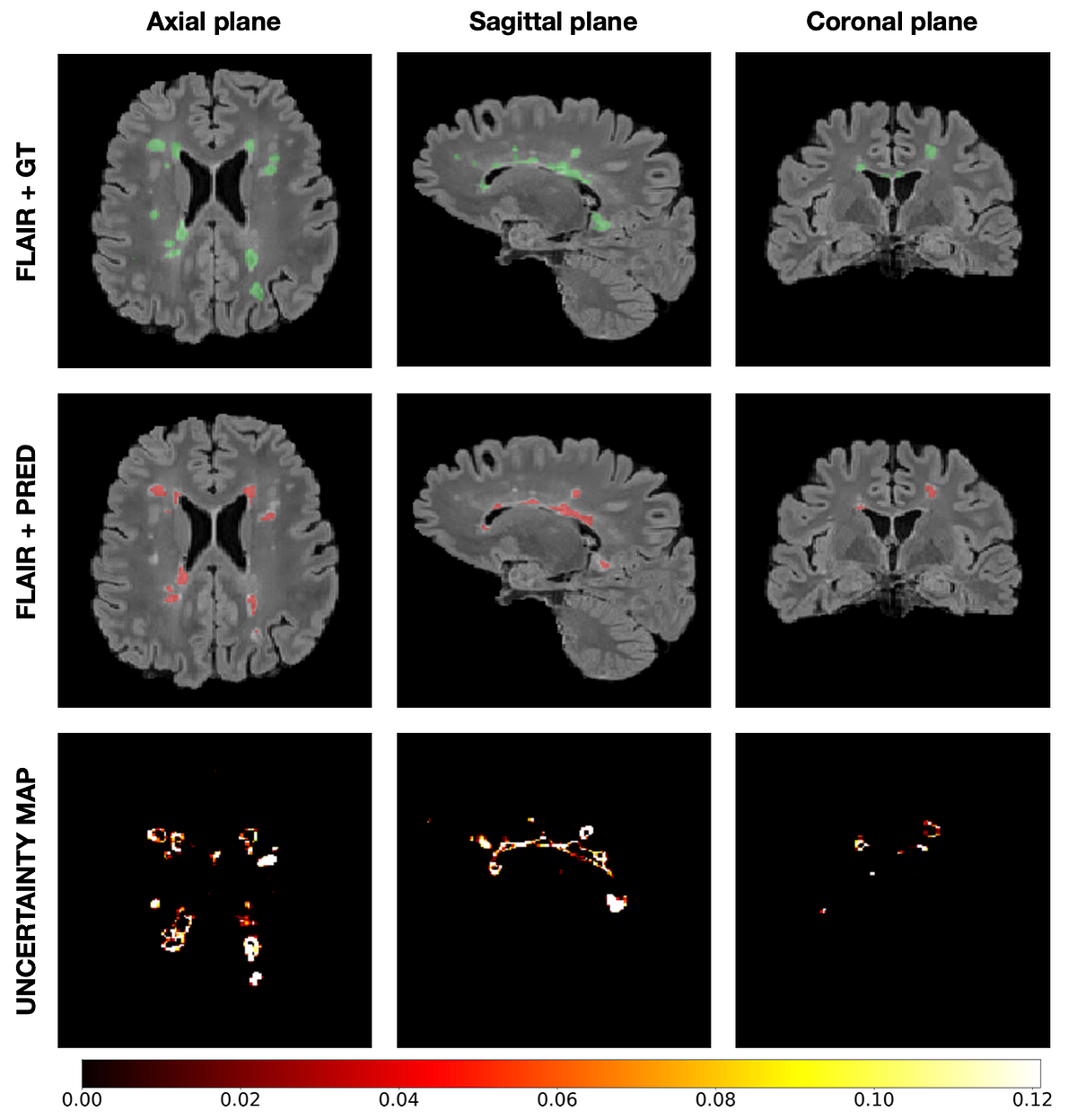 Shifts Challenge 2022: Multiple Sclerosis Lesion Segmentation Track ...