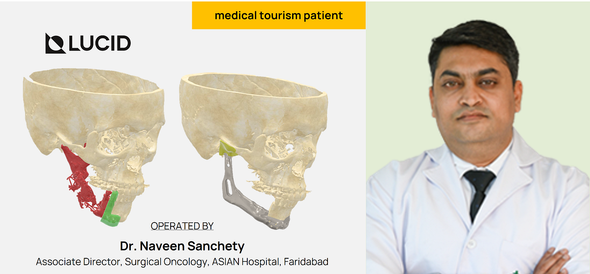 Benign Tumor of Mandible — A Case Study | by Dr. Pranav Sapkal | LUCID ...