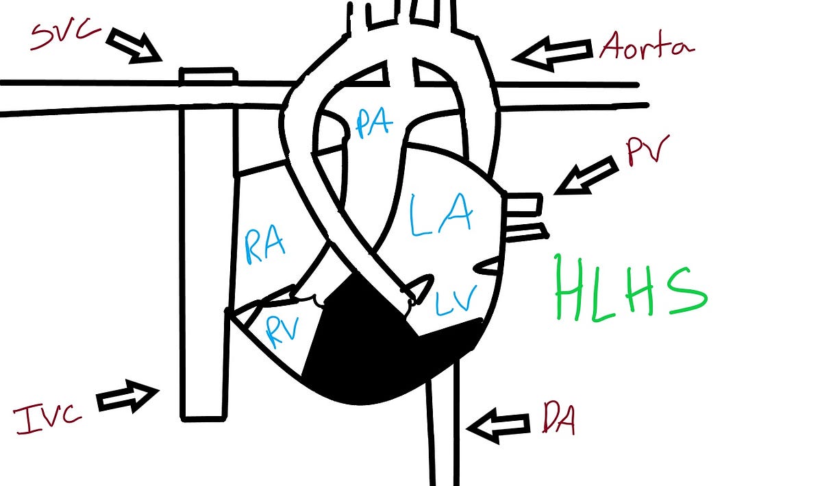 Hypoplastic Left Heart Syndrome Anatomy, A Simple Rundown | by Zachary ...
