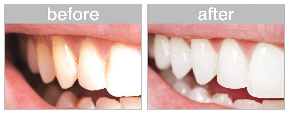 What are the Different Types of Teeth Cleaning? | by ...