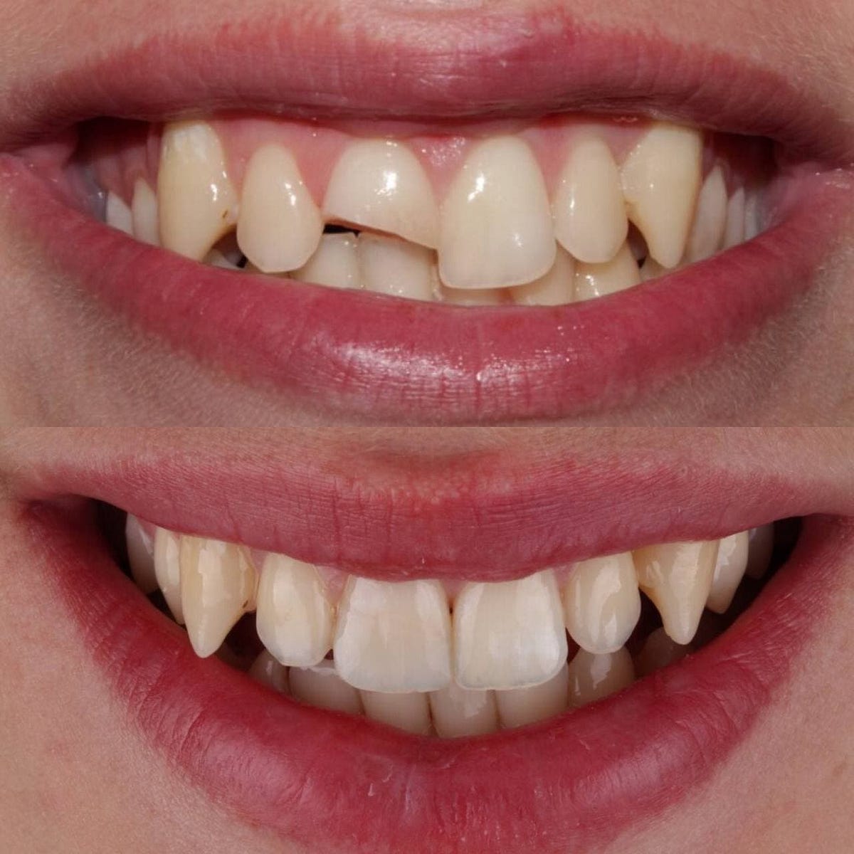 Radiant Smiles: The Art of Cosmetic Filling Treatments in Kandivali ...