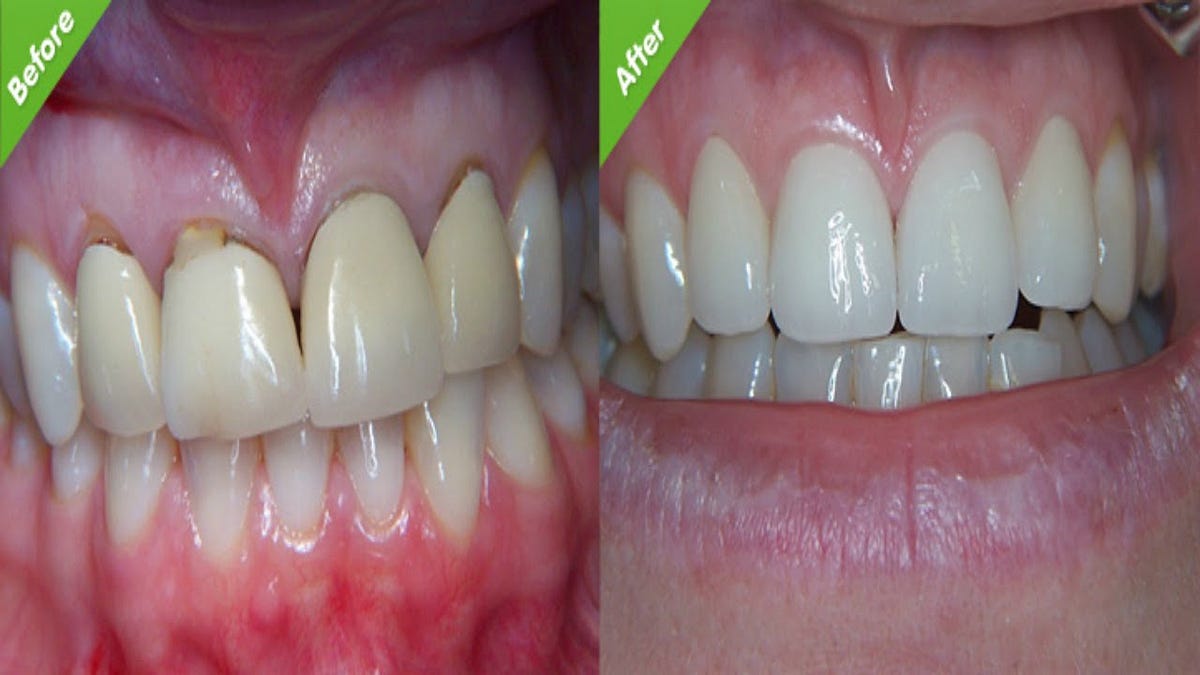 Ouch or Smile? Delhi’s Guide to Root Canal & Invisalign Costs | by ...