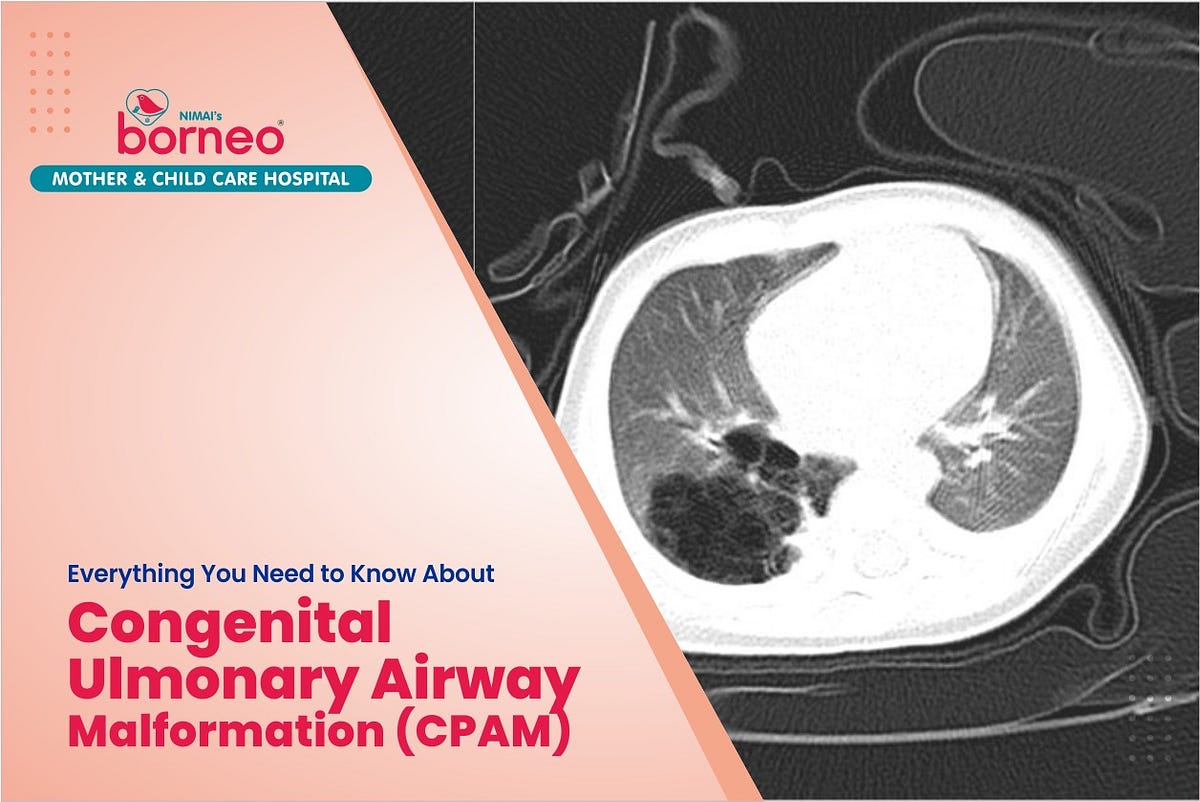 CPAM — What Is It And How Does It Develop? | by Borneohospital | Jan ...