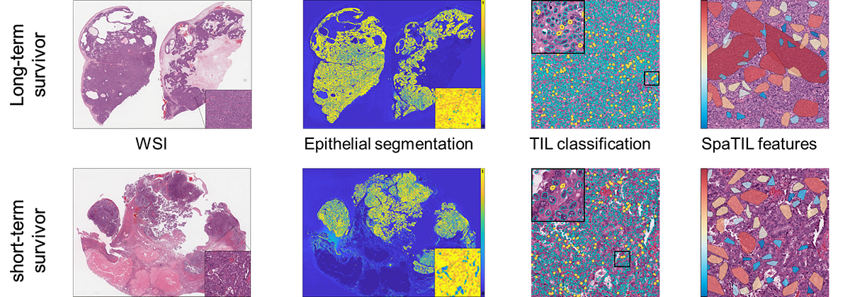 Computer-extracted features related to the spatial arrangement of tumor ... Computer-extracted features related to the spatial arrangement of tumor ...