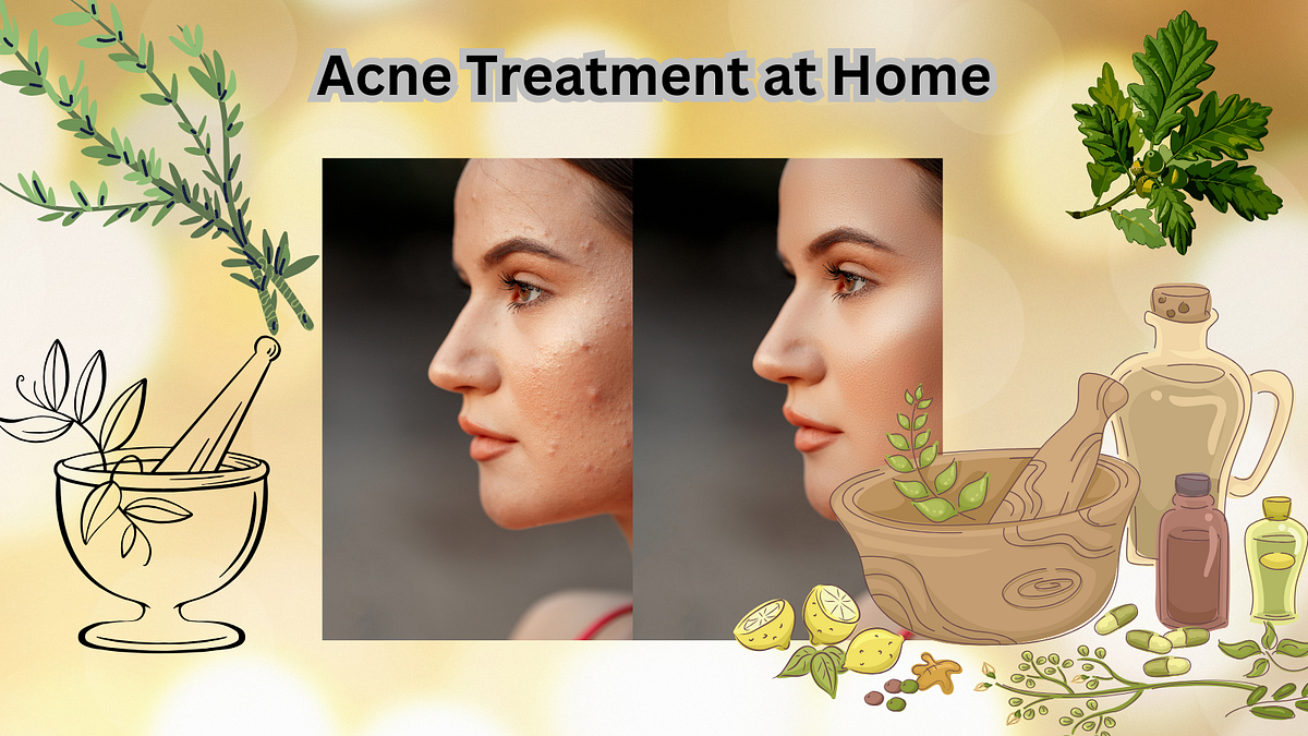 Achieving clear pores and skin: a powerful acne remedy at home | by ...