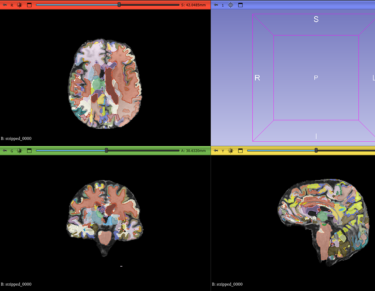 Tutorial: Segmenting Your Brain in MRI — No Installation, Just Containers! | by Mithilesh | Medium