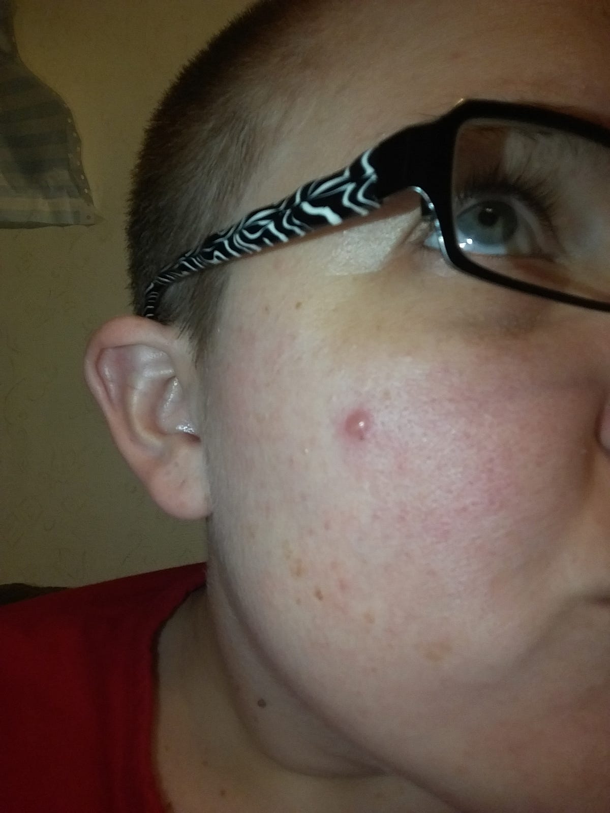 Painful Zit. Painful zit | by Chanel Silver | Medium