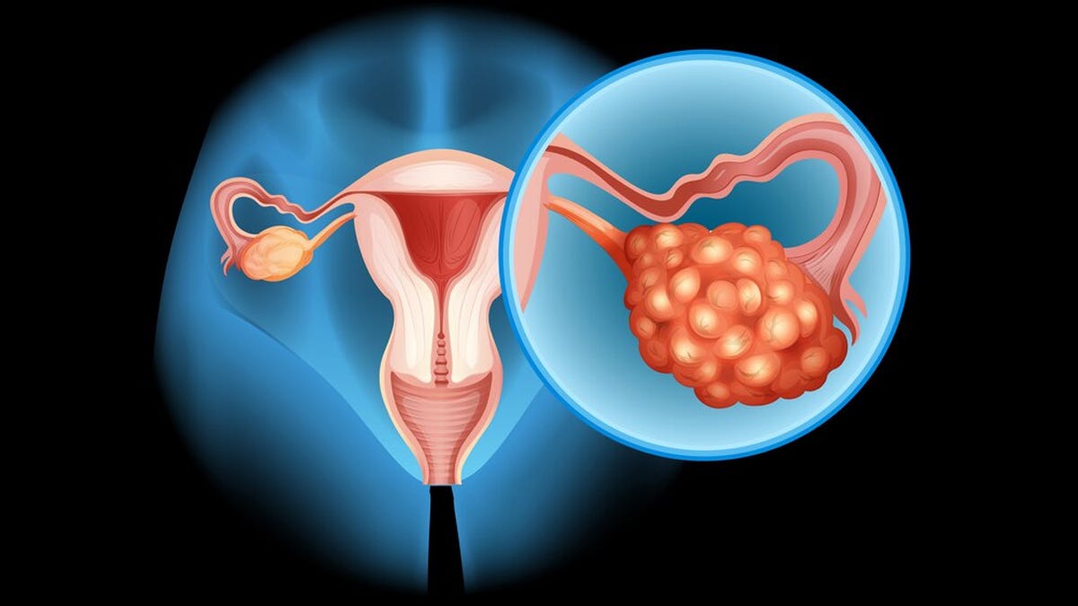 PCOS Diagnostic Market Expected to Grow Rapidly owing to Advancements ... PCOS Diagnostic Market Expected to Grow Rapidly owing to Advancements ...