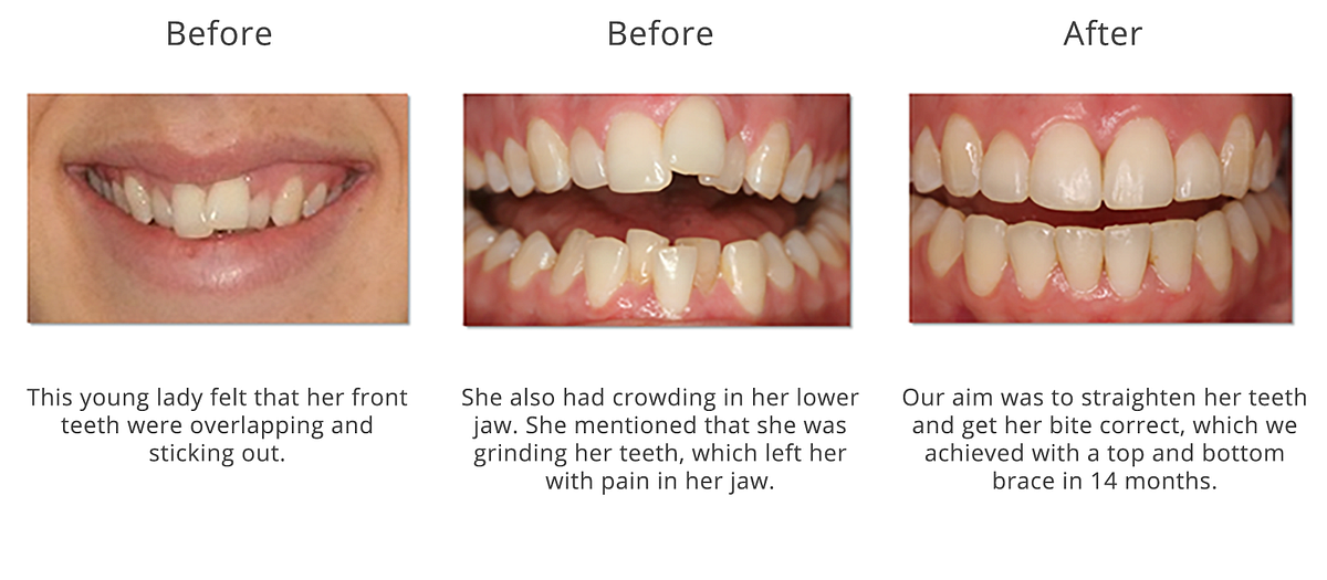 How Braces Help in Straightening Teeth for Adults and Children | by ...