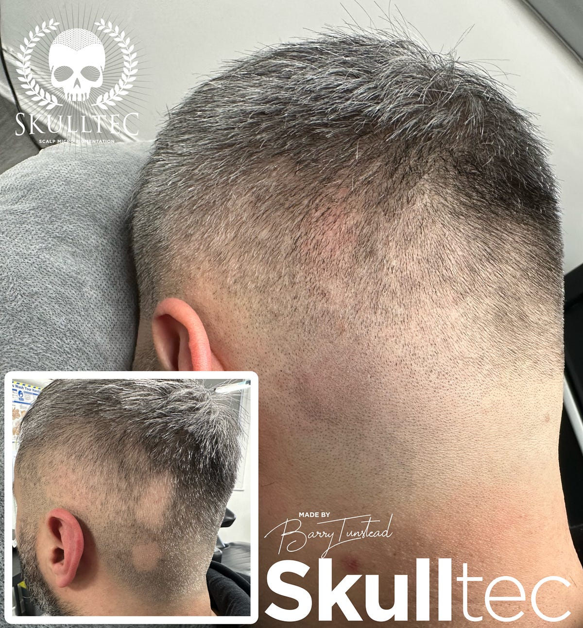 Is Scar Camouflage with SMP an Invasive Procedure? - Skulltec Scalp ...
