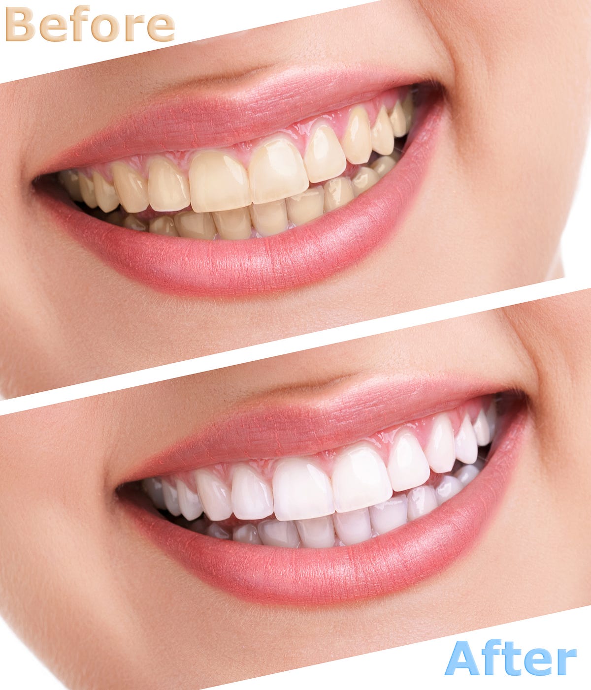 Here are Basics of Teeth Whitening Procedure | by MelbourneDentist | Medium