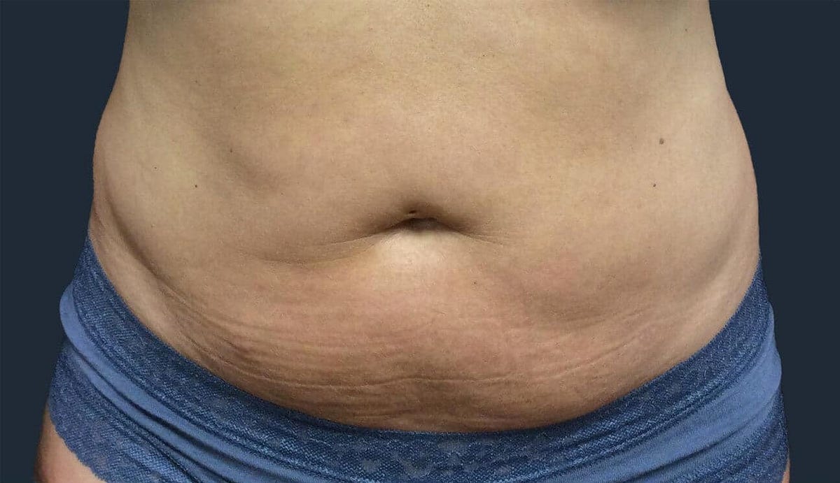 Non Surgical Fat Reduction Dermedica Cosmetic Clinic Dermedica
