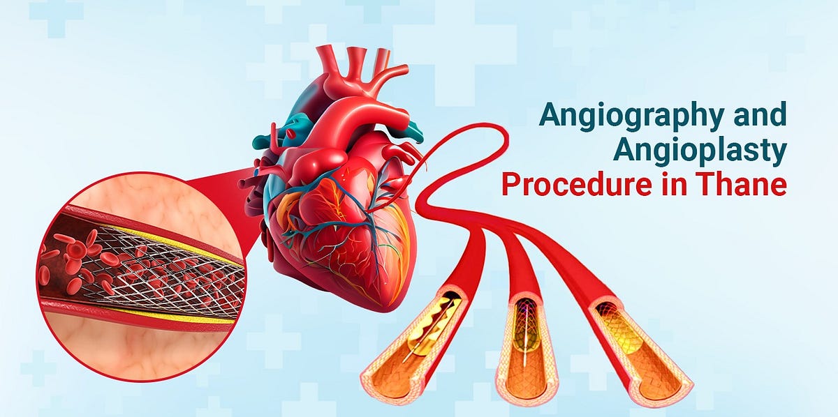 Your Ultimate Handbook on Angiography and Angioplasty at Jinkushal ...