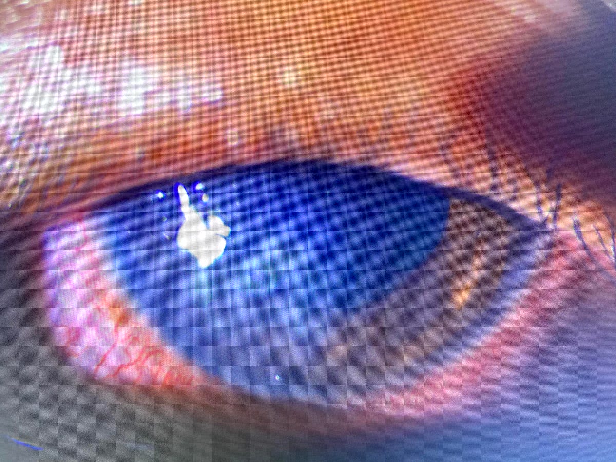 Cornea Ulceration Part 2. Ulceration (or Ulkus in Bahasa… | by Dennis Widjaja | Medium