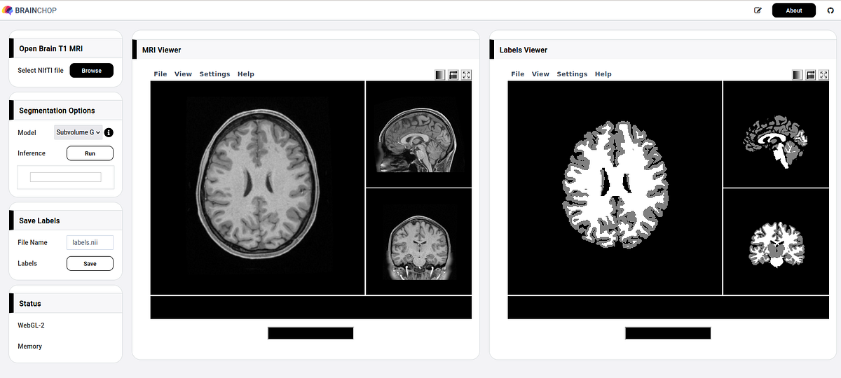 Brainchop: In-browser 3D MRI Segmentation | by Mohamed Masoud | Medium