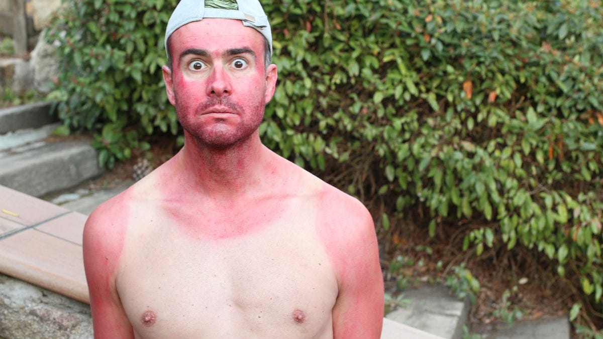 The Most Sunburnt You’ve Ever Been? | by Michael Rhodes | Medium