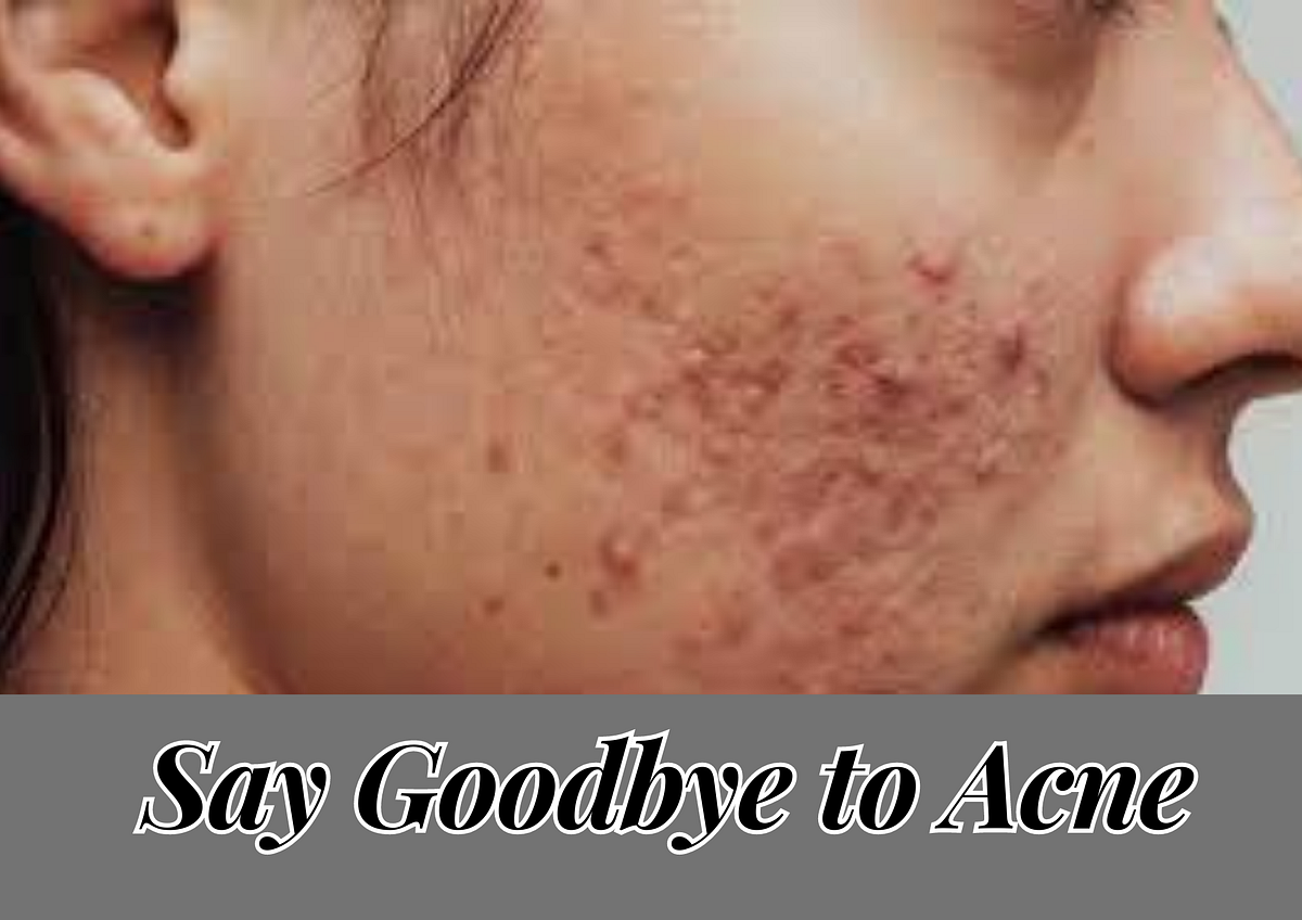 Say Goodbye to Acne : How to Achieve a Spotless Complexion with Simple ...
