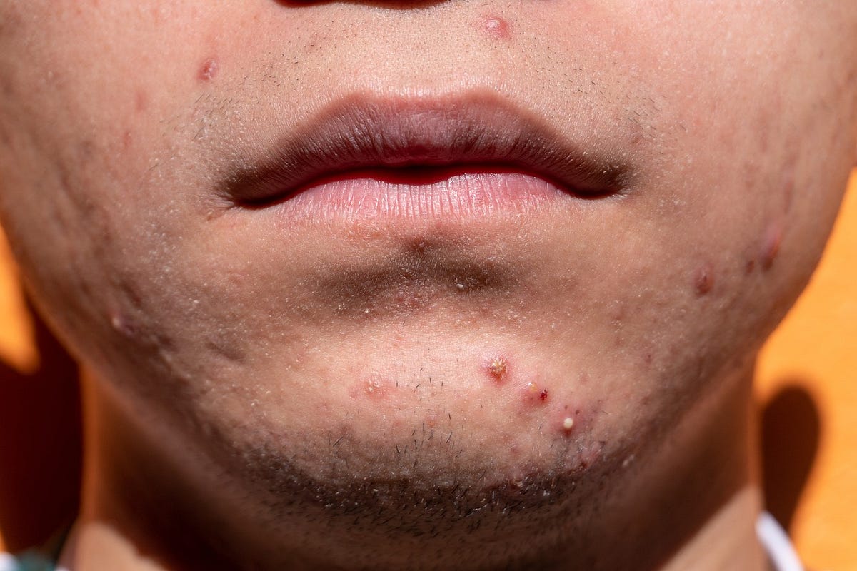 How to Deal with Acne Around Your Mouth? Facts and Tips | by kcornelia ...