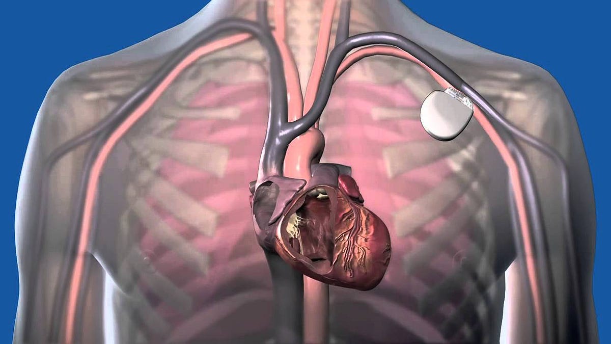 Cardiac Implantable Electronic Device Market Driven By Growing ...