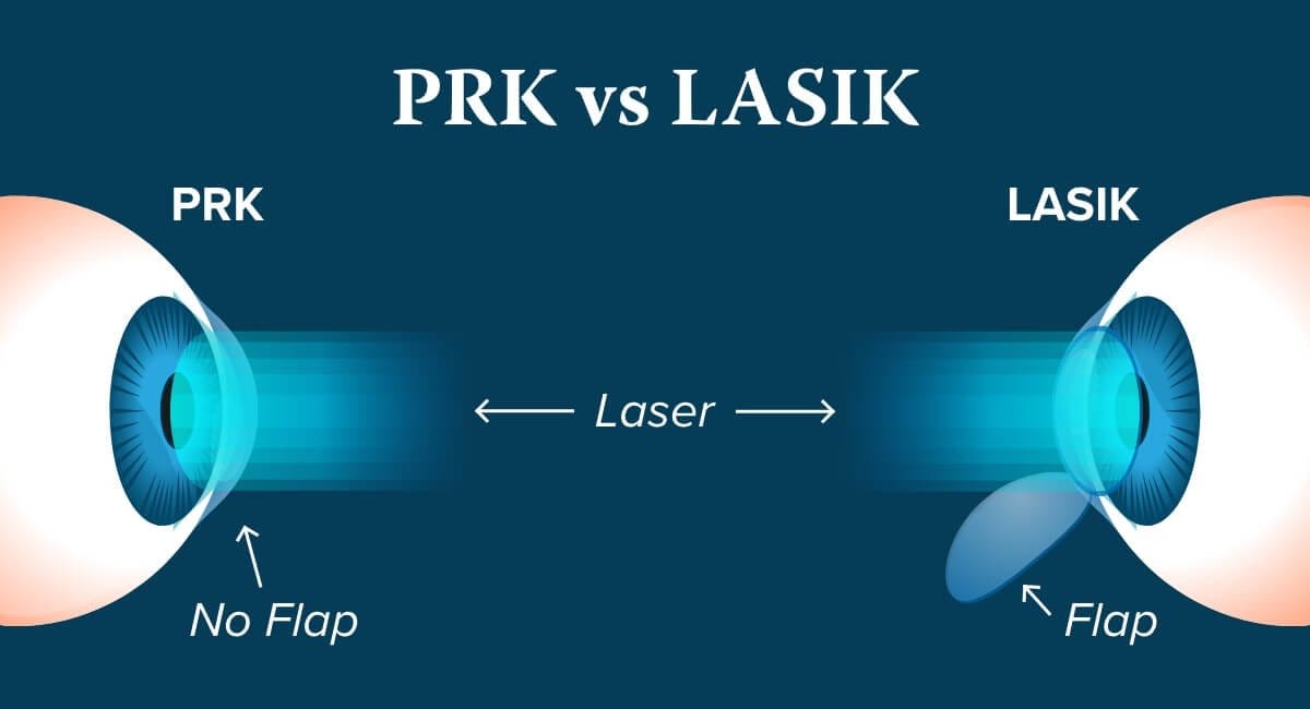 PRK vs. LASIK: Which is Better?. When considering corrective eye… | by ...