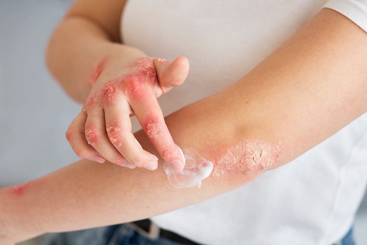 Skin Cancer: Awareness, Prevention, and Treatment in India | by Gopal ...