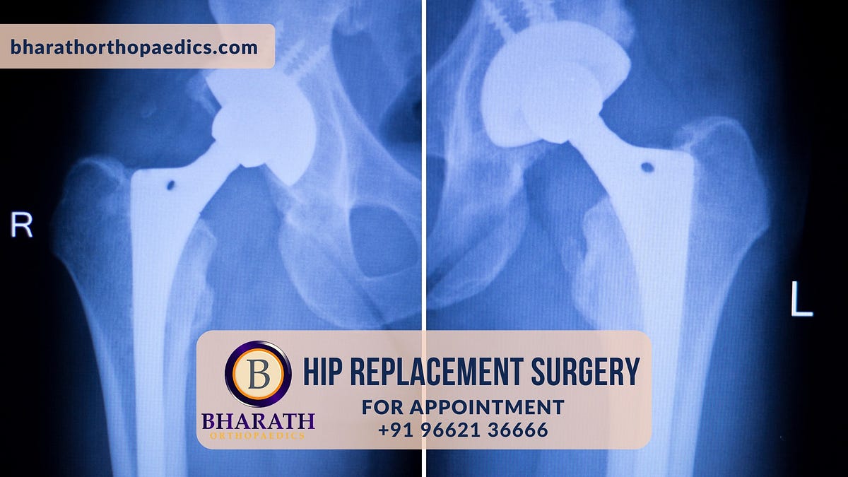 Hip Joint Replacement in Chennai. Understanding Hip Joint Replacement | by Bharathortho | Jun ...