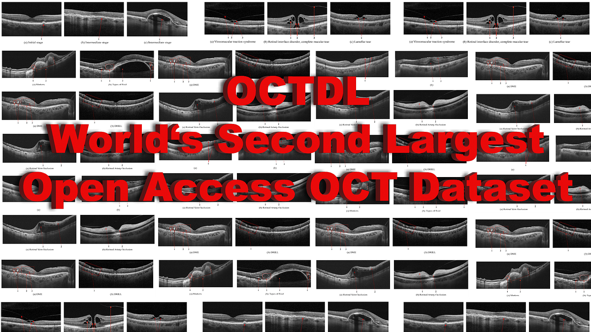 OCTDL — The Second Largest Open Access Dataset for OCT | by Andreas ...