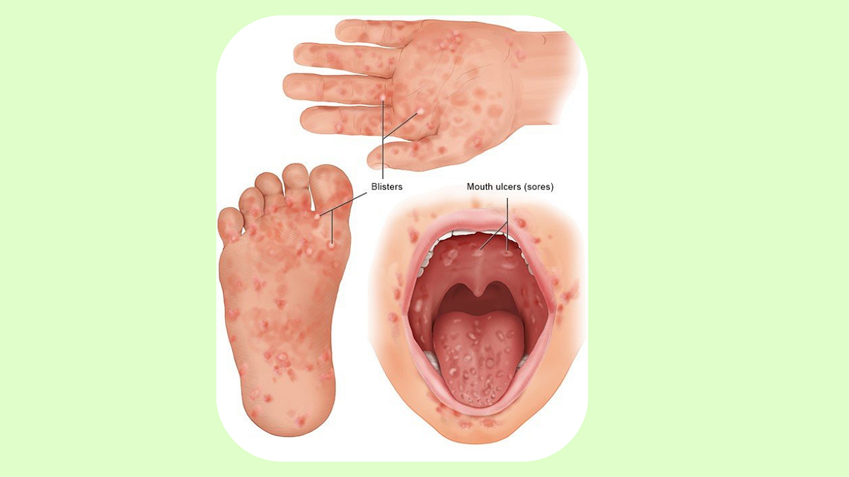 Hand, Foot and Mouth Disease (HFMD): Symptoms, Treatment and Prevention ...