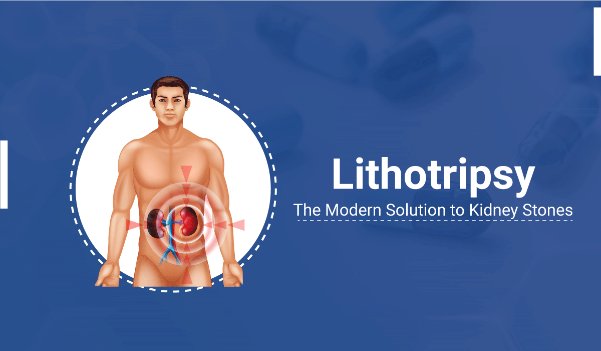 Lithotripsy: The Modern Solution To Kidney Stones | by ...