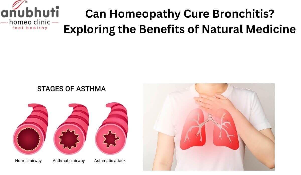 Can Homeopathy Cure Bronchitis? Exploring the Benefits of Natural ...