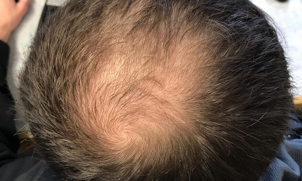 Expert Advice and Effective Solutions to Treating Androgenic Alopecia ...