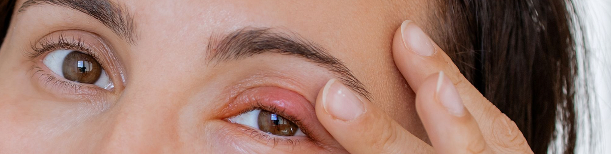 Swollen Eyelids. Swollen eyelids are a common medical… | by Wellyme ...