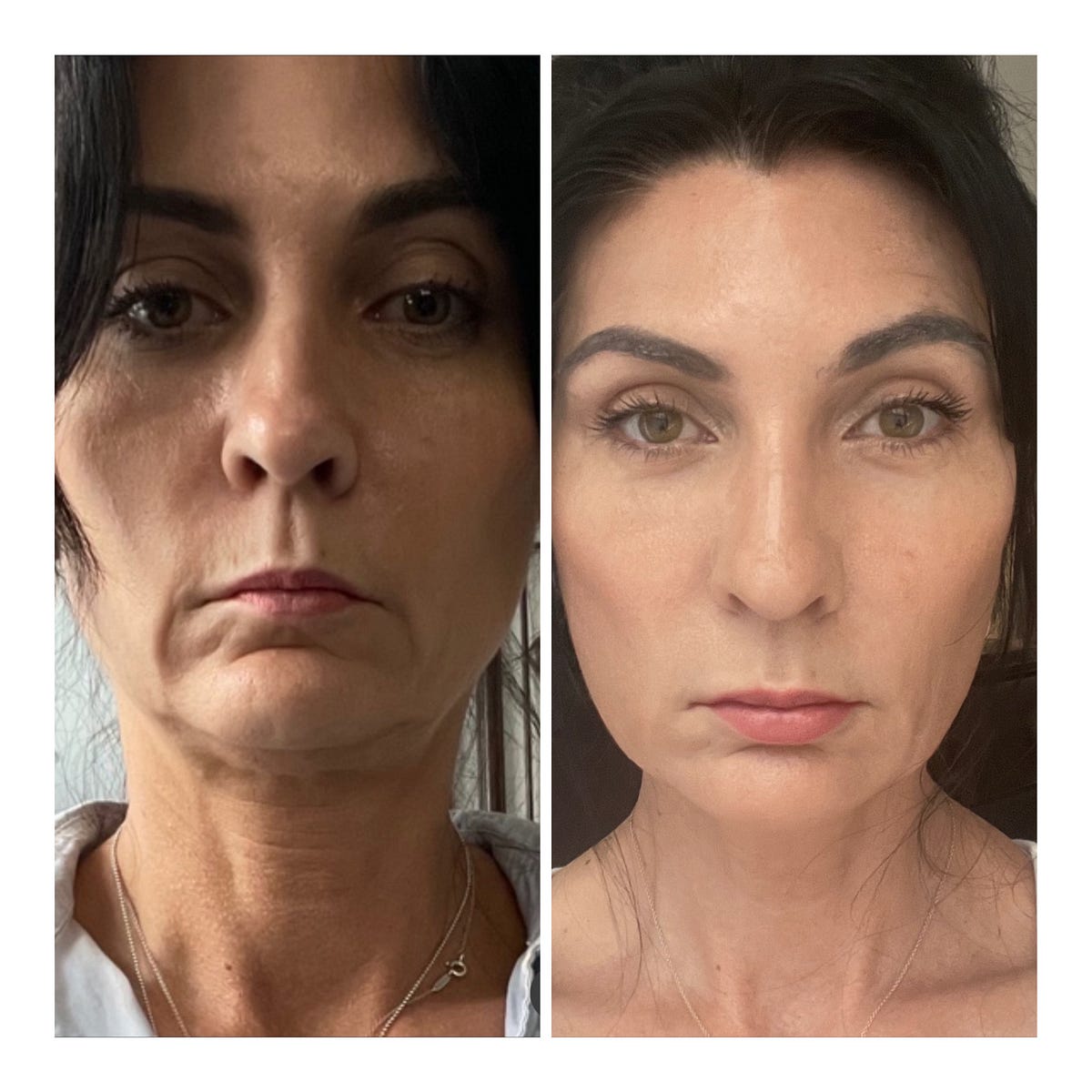 My Lunchtime Facelift. A thread lift literally took years off… | by ...