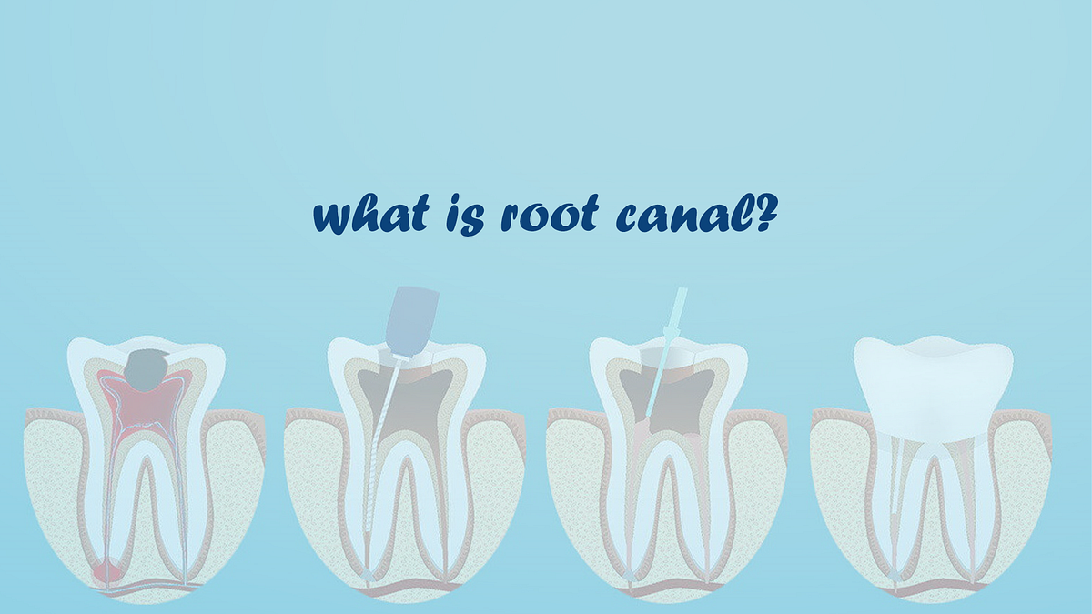 Root canals: what are they , how to treat them , what are the causes ...