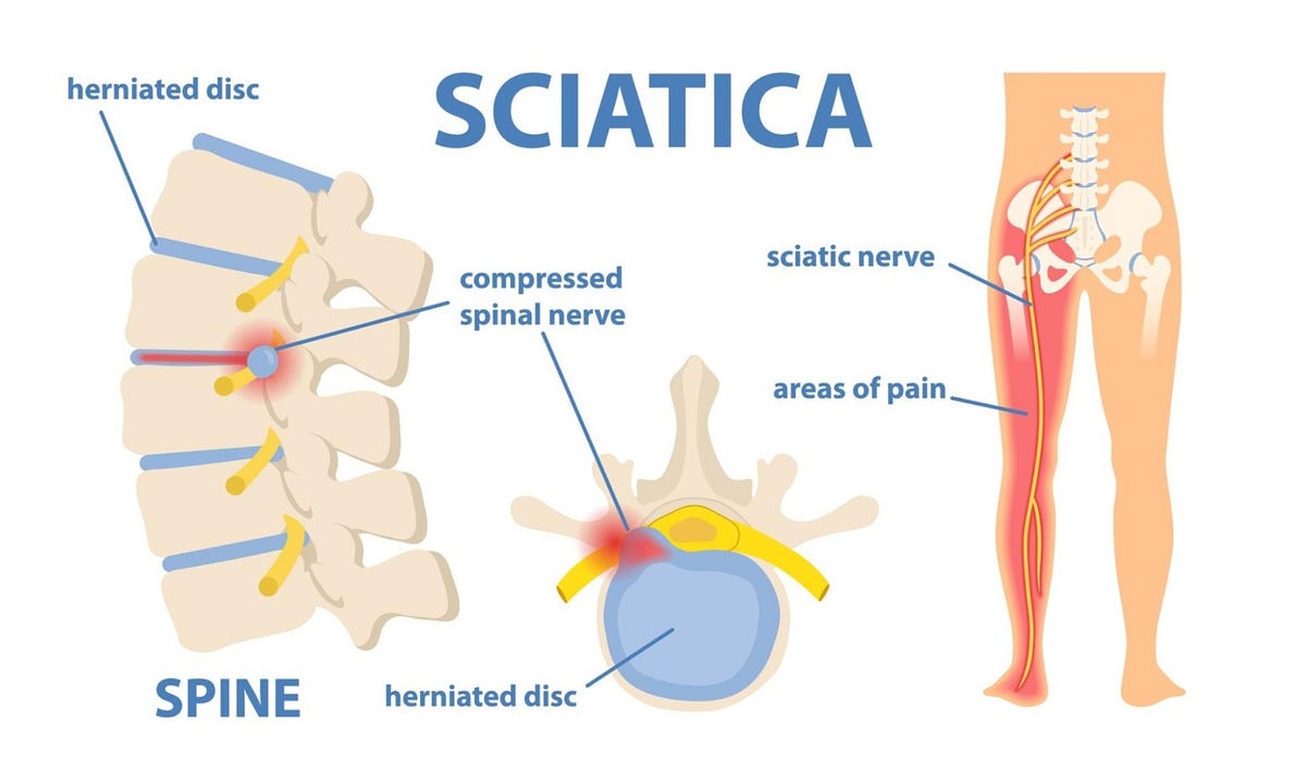 Effective Sciatica Pain Treatment: Finding Relief and Recovery | by Gilbertphysical | Feb, 2024 ...