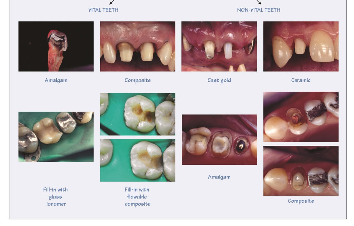 Coronal support буюу core build-up ажилбарын тухай | by GANTUMUR.DDS ...