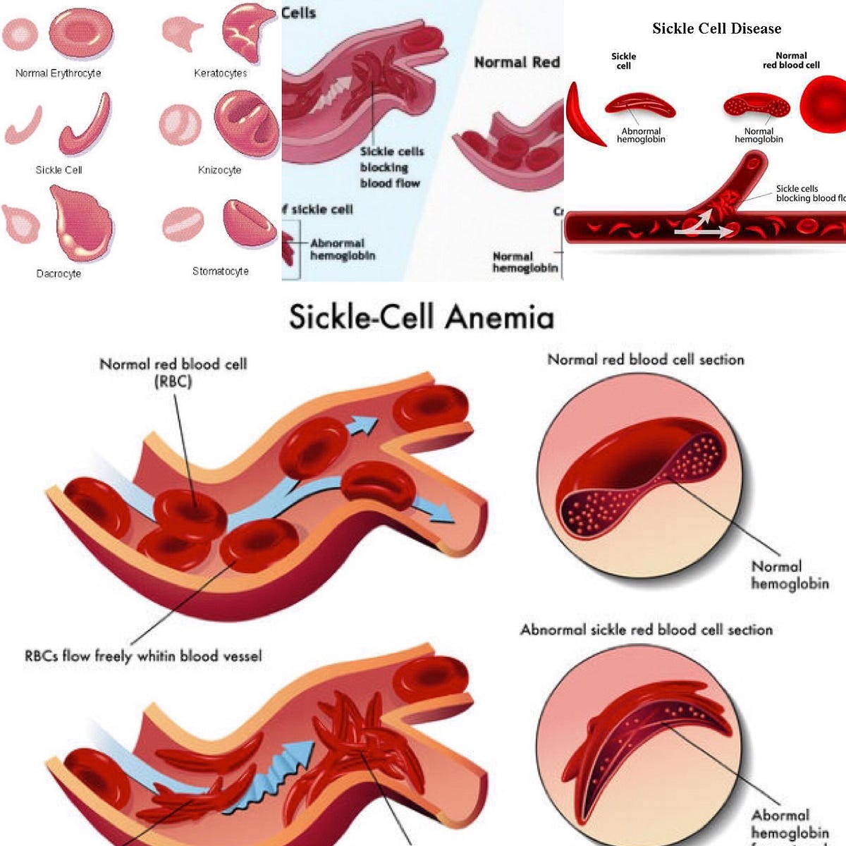 Sickle Cell Natural Healing. Post by ~ Anthia Lee | by Finest Herbal Shop LLC | Medium