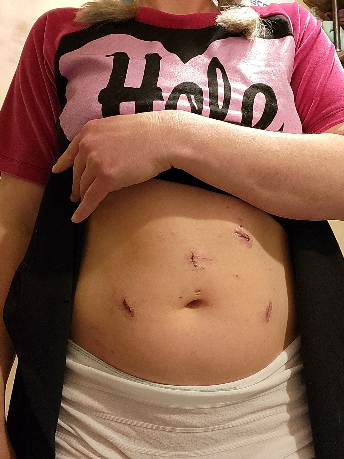Lovenox Bruises