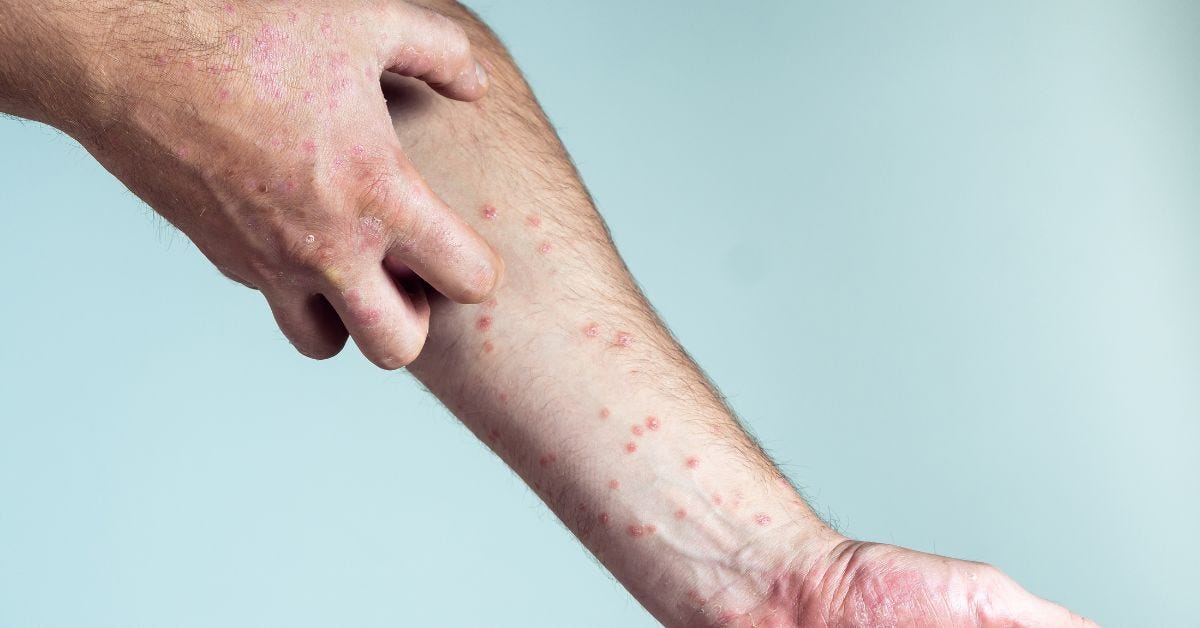 Beriberi: A Comprehensive Guide to This Nutrient Deficiency Disease ...