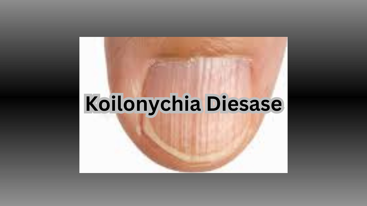 Koilonychia Understanding Ladle-Shaped Nails and Their Underpinning ...