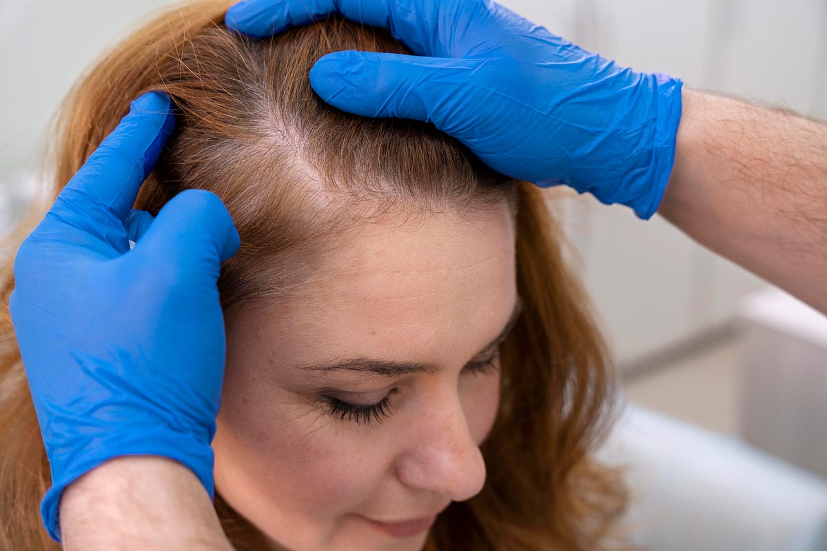 5 Reasons Why PRF and PRP are Effective for Hair Loss | by GS Beauty ...