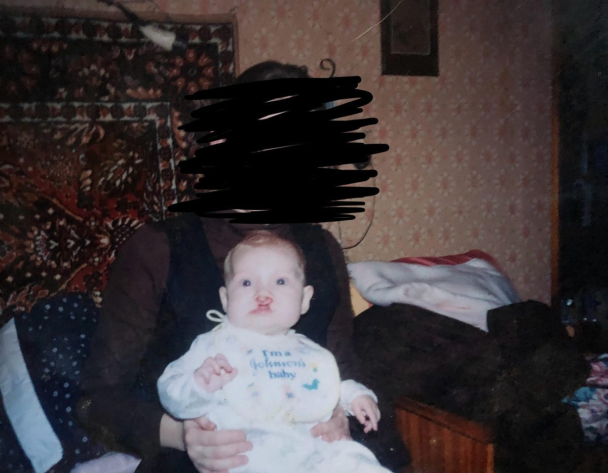 Living with a birth defect. I was born with bilateral cleft lip and ...