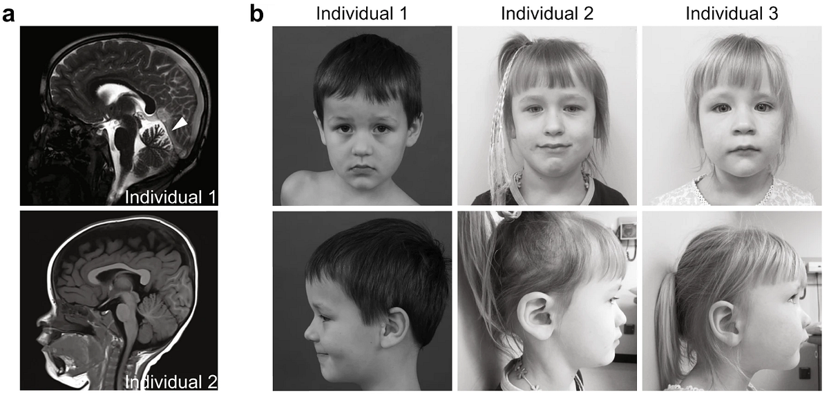 NIH Scientists Discover A Rare Genetic Brain Disorder Making Children ...